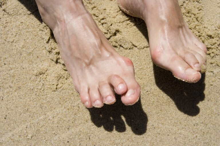 Why Are My Toes Crooked? - Podiatrist in Newtown, PA