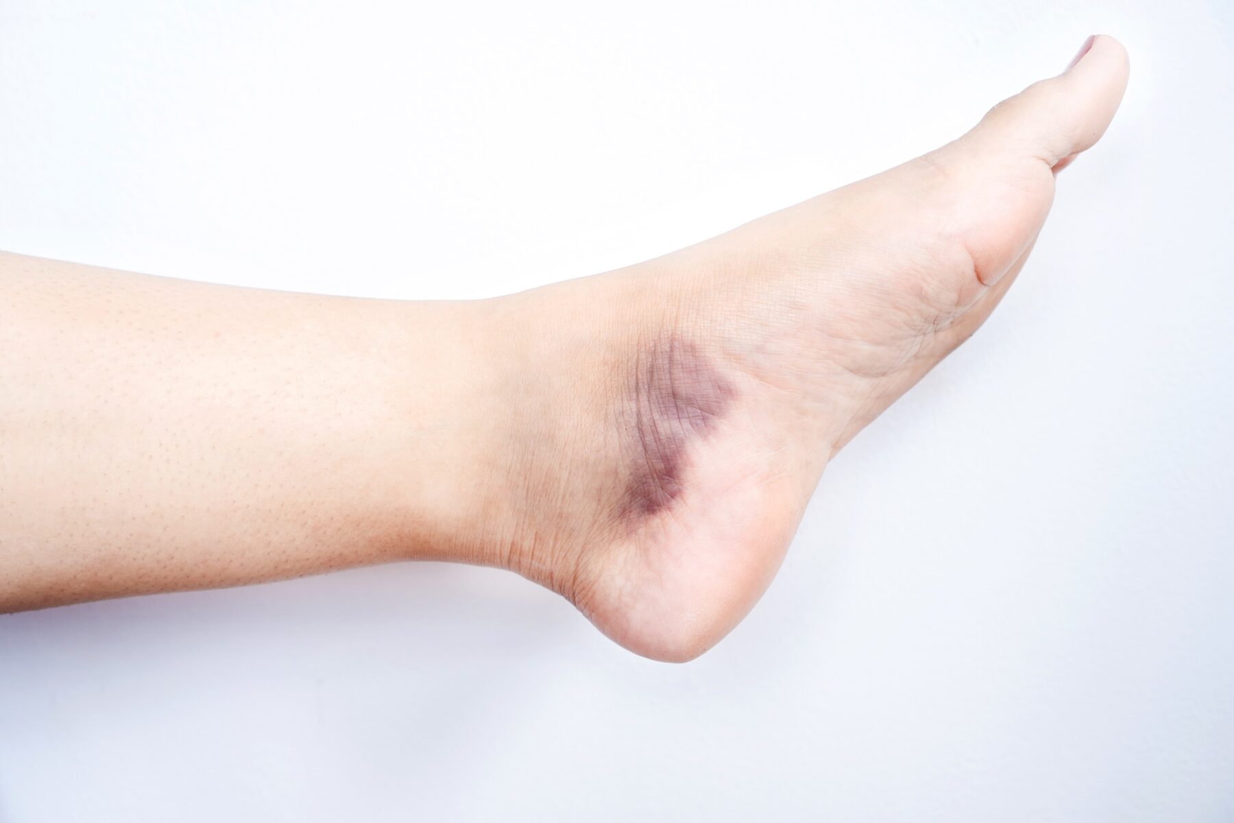 Do You Have Discolored Feet? - Foot Specialists Newtown, PA
